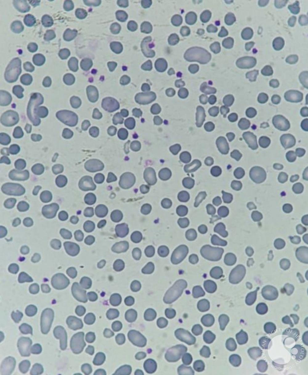 Anemia - hematologiaclinica.net